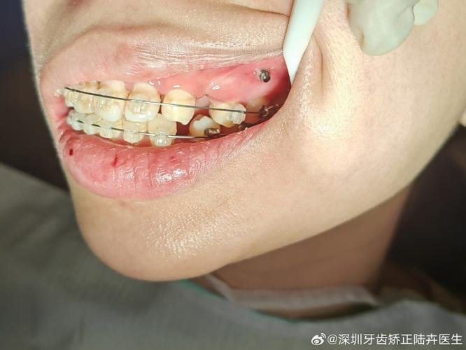 骨钉周围牙龈白色图标