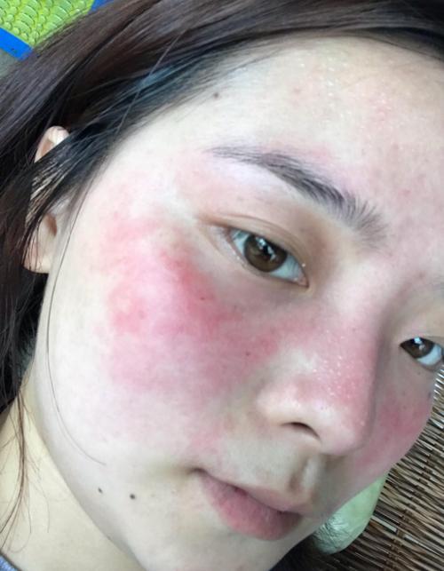 脸上皮肤薄是什么原因图标