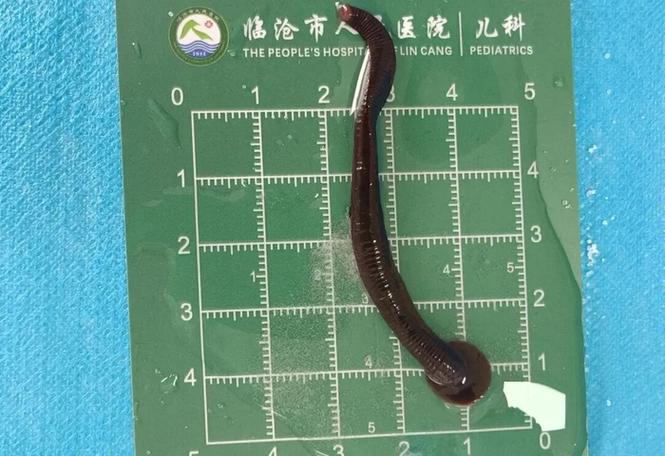 幼童气管内竟藏8厘米蚂蟥截图