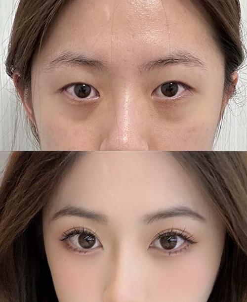 双眼皮变单眼皮还能变回来吗图标
