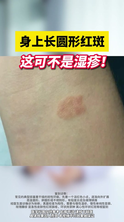 脸上一块红红的像癣怎么办图标