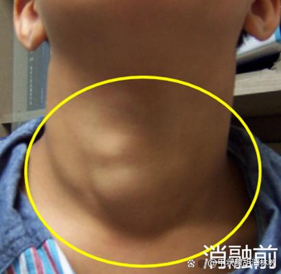 桥本甲状腺和甲状腺结节哪个严重图标