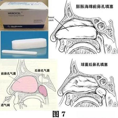 流鼻血鼻腔填塞如何取出