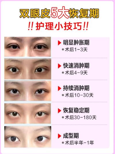 埋线为什么不建议做图标