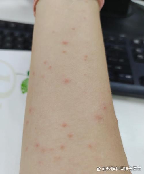 hpv病毒身上会有小红点吗图标
