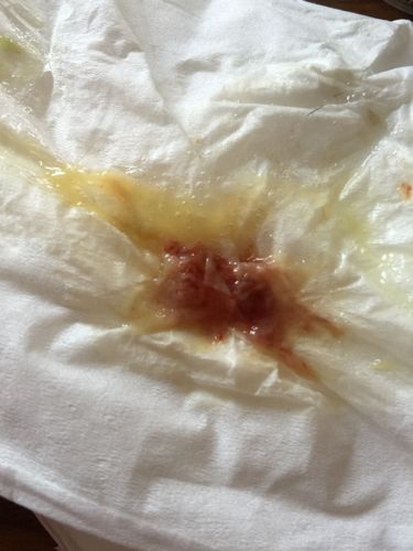 擤鼻涕擤出一坨浓黄胶状截图