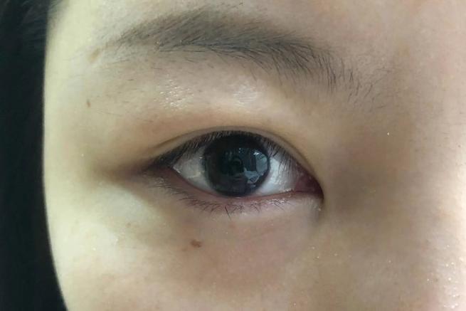 泡泡眼