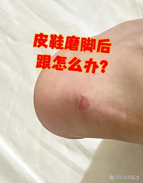 鞋子踢破皮了怎么办图标
