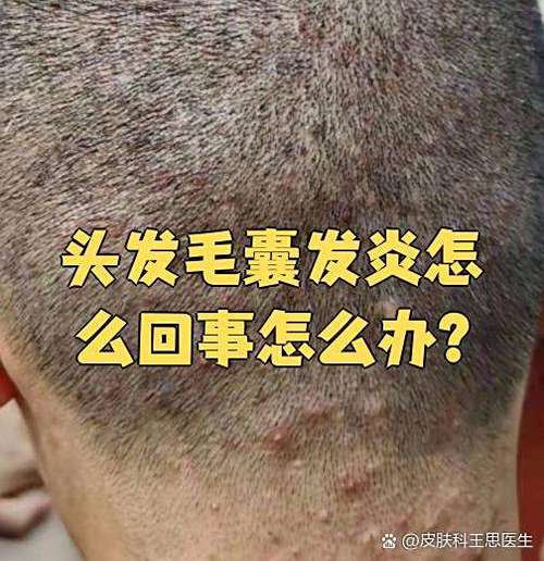 头发毛囊炎的症状图标