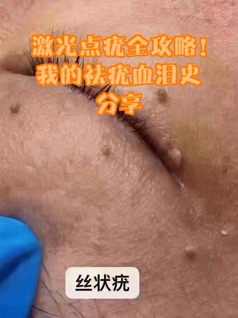 滴优真的可以祛疣吗截图