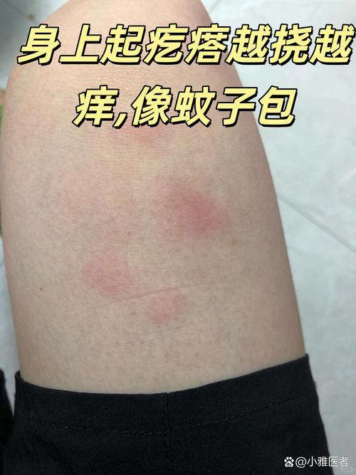 身上很痒一挠就会起包图标