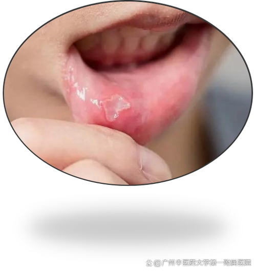 沈阳看口腔溃疡哪个医院好图标