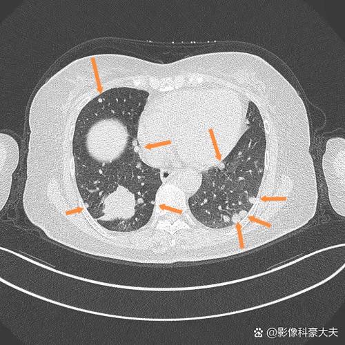 做胸透有金属会怎样图标