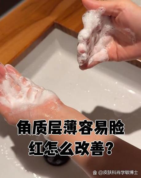 角质层薄容易脸红怎么改善图标