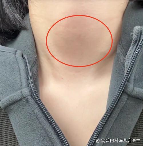 无痛性甲状腺炎误诊桥本截图