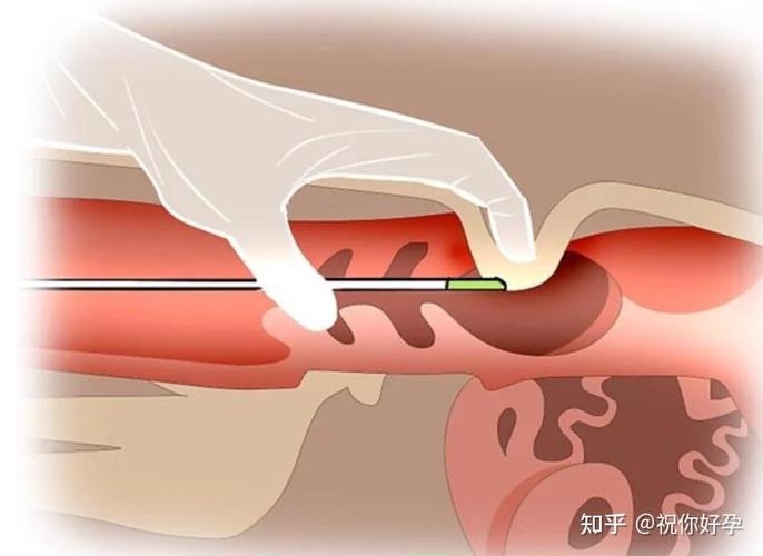 医院人工取精怎么取图标