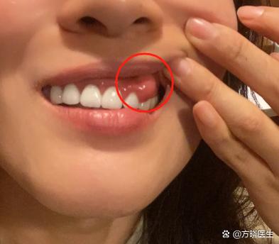 牙龈肿胀鼓包是什么原因图标
