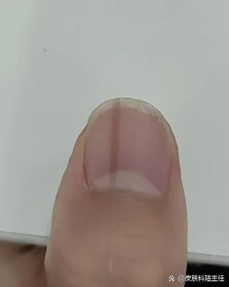 大拇指指甲上有竖纹黑线图标