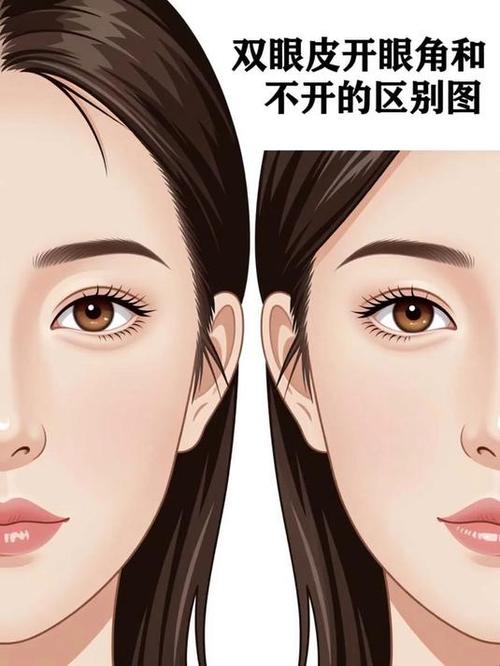 做双眼皮开眼角好还是不开眼角好图标