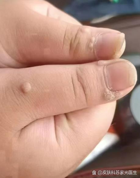 手上长了一个肉包截图