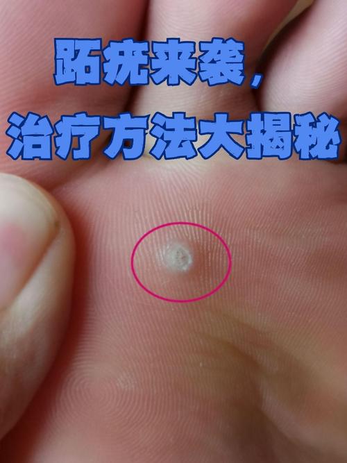 跖疣图片图标