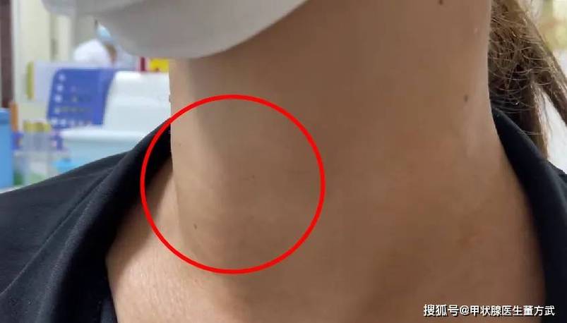 甲状腺乳头状癌伴桥本氏病图标