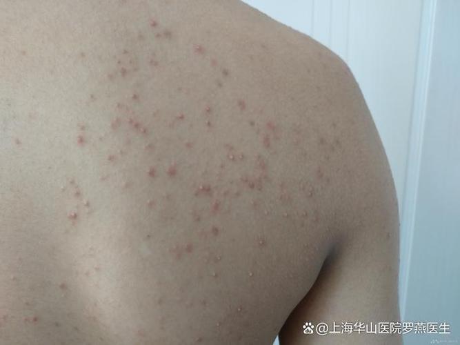 毛囊炎的10种图片图标