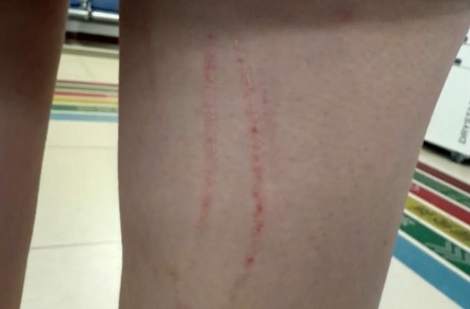 狗抓伤是一条线还是几条