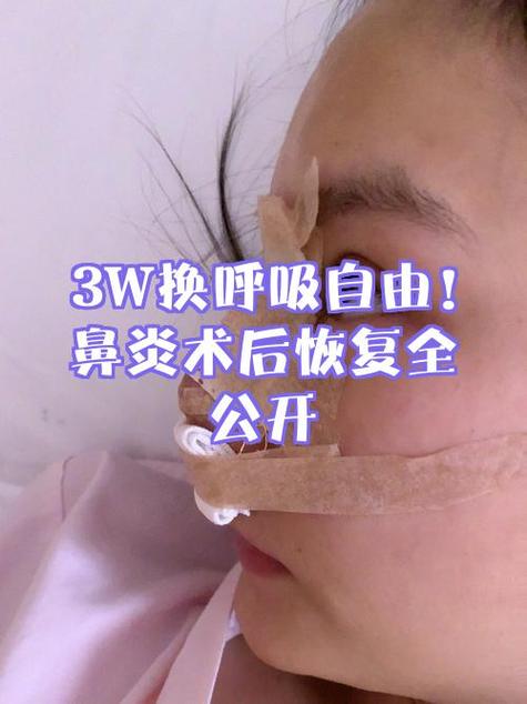 鼻炎用鼻炎膏管用吗图标