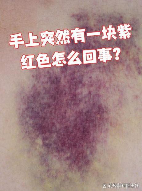 手背用力扯出紫红块按压变色