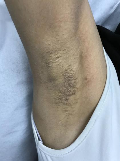 女性腋窝发痒要警惕图标