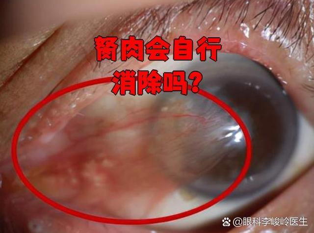 胬肉是什么意思图标