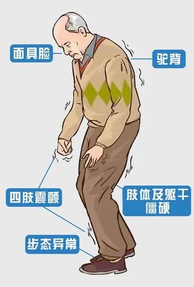 帕金森病的症状表现有哪些截图