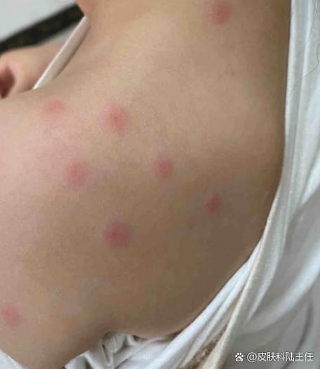小孩身痒一抓一个疙瘩截图