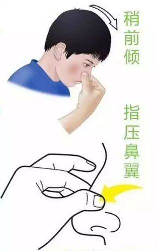 怎样才能阻止流鼻血截图