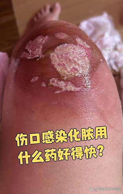 烫伤化脓了用什么药好得快图标