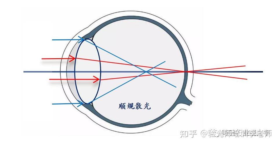 散光是怎么造成的图标
