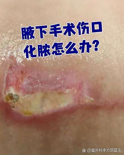 伤口一直流水不愈合怎么办图标