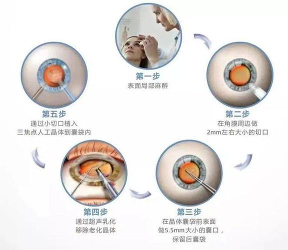 散光矫正图标
