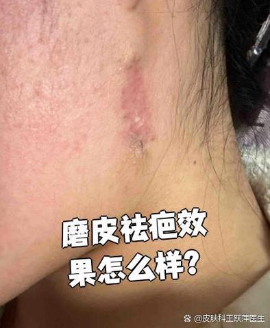 皮肤磨皮手术截图