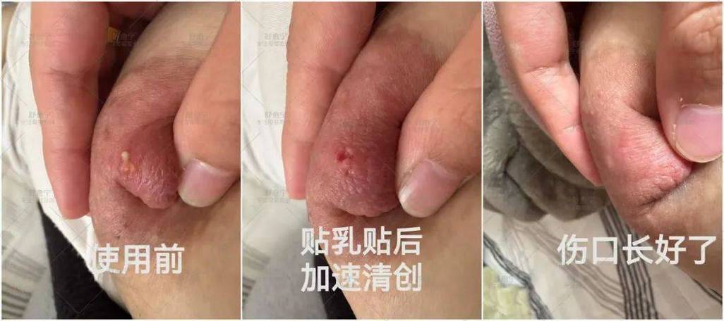 乳头小白点的处理方法截图