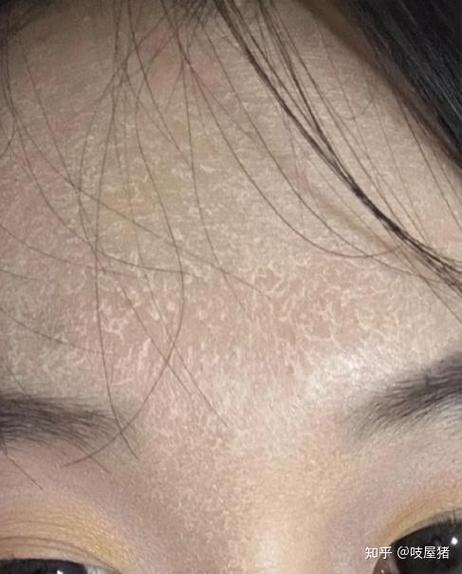 皮肤长一层新皮要多久截图