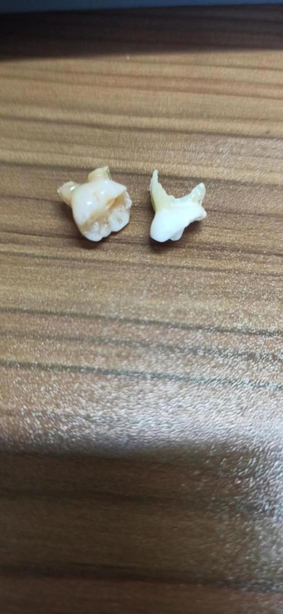 掉大牙意味着什么意思截图