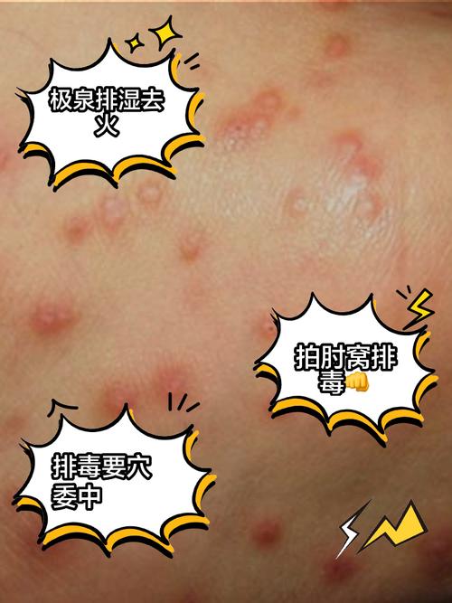 湿毒是什么截图