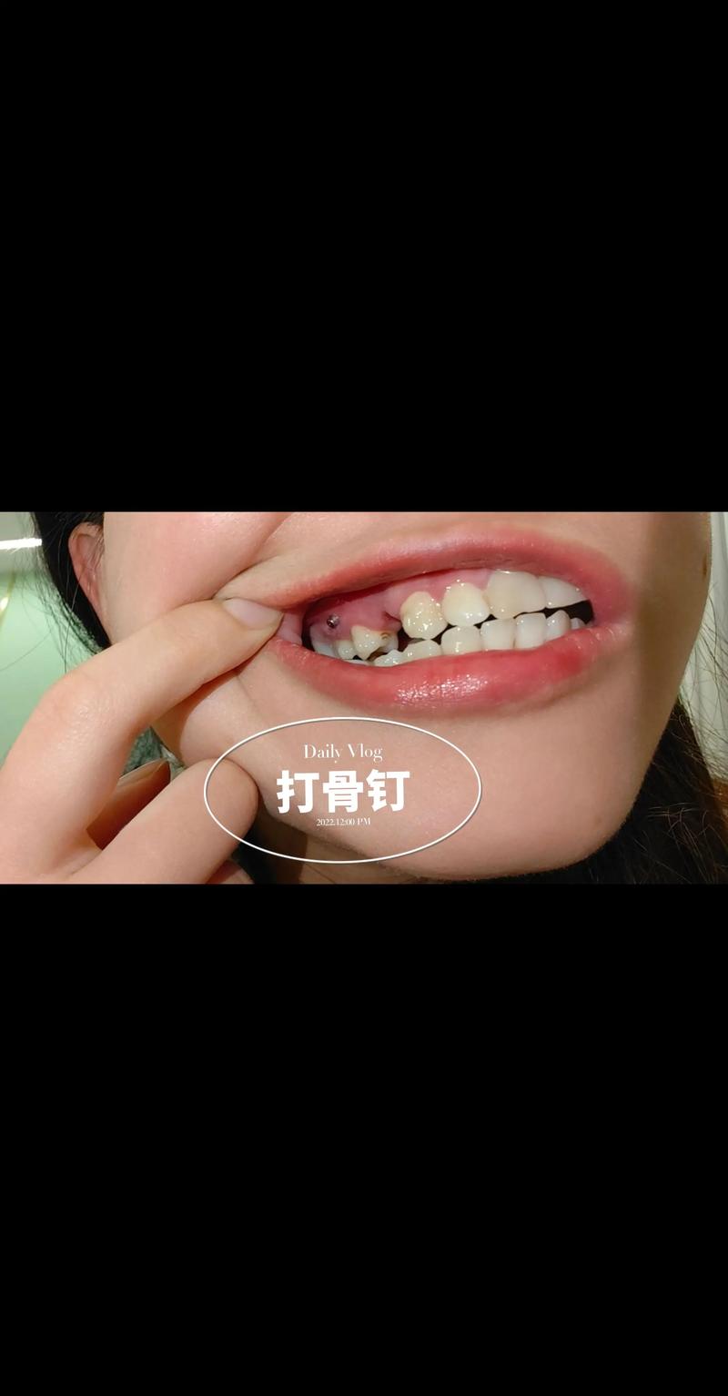 骨钉周围白白的