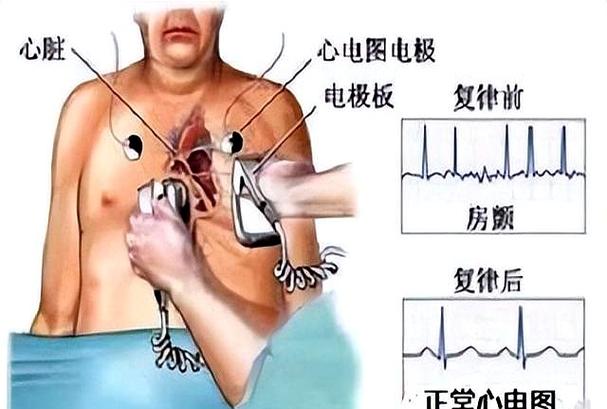 人一旦电复律就意味着什么图标