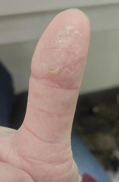 指纹脱皮之后指纹还一致吗图标
