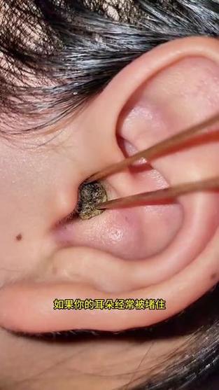 可视挖耳勺看不清楚耳道