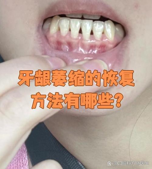 牙龈萎缩最佳恢复方法图标