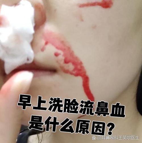 早晨流鼻血是什么预兆